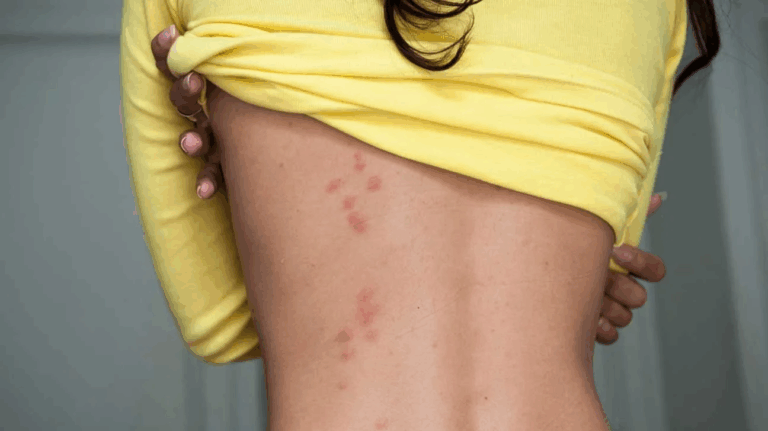 Bed Bug Bites Triangle: How to Spot, Treat & Stop Them Now